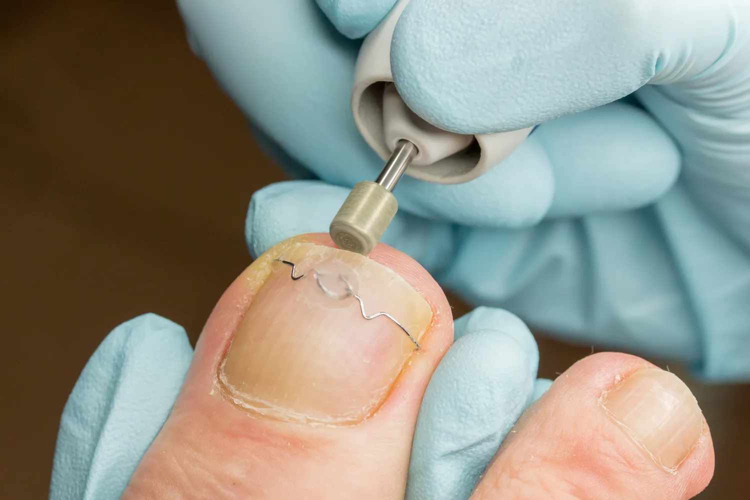 Jak podolog usuwa odcisk? - Wolf Project